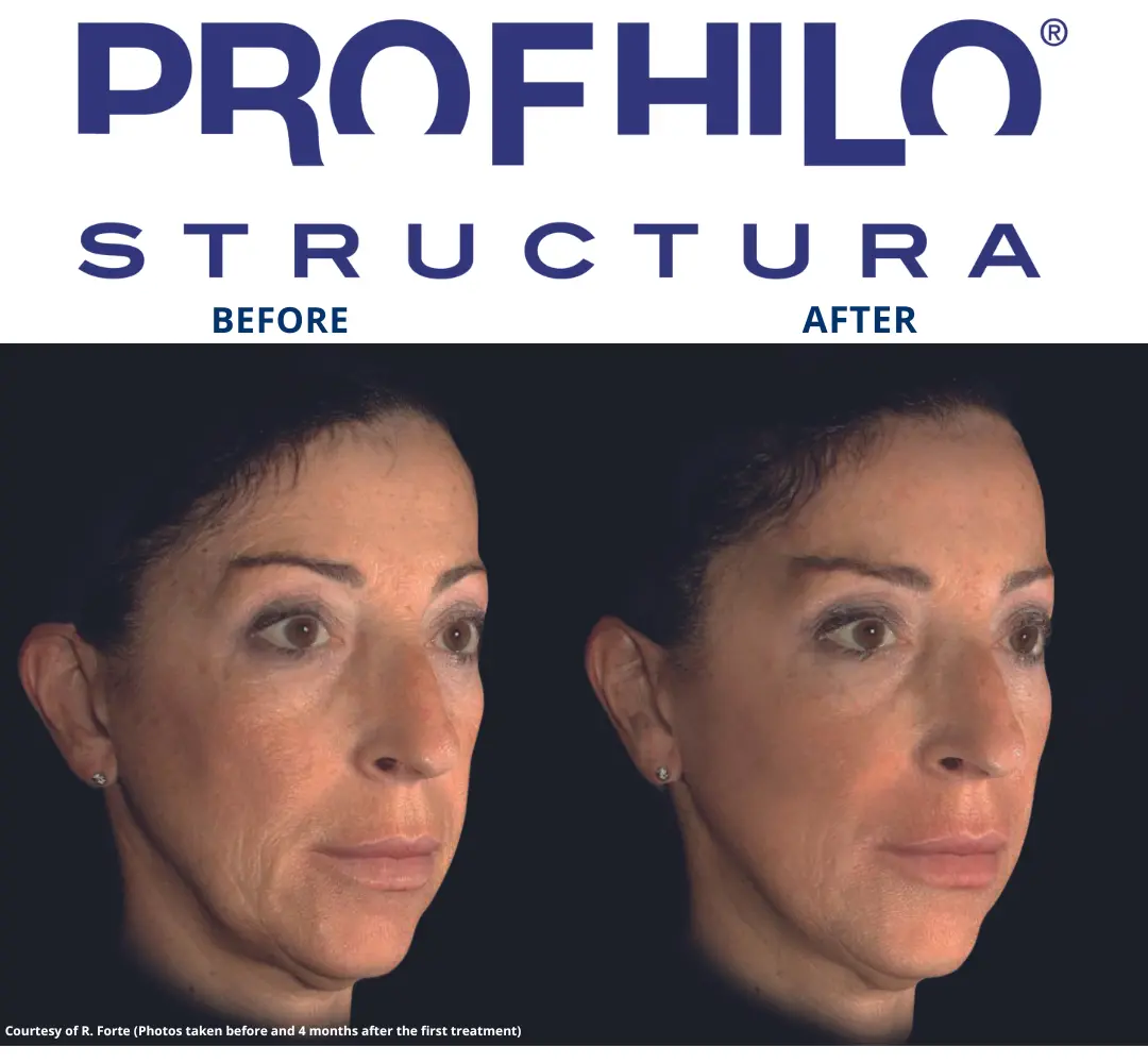 Profhilo Structura Treatment - Nordic Skin Clinic